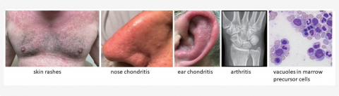 Vexas syndrome test - DiaCarta, Inc.